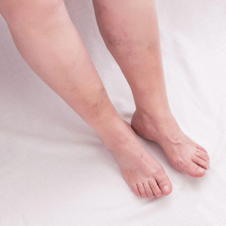 Tout savoir sur l'insuffisance veineuse des jambes - Le Mag NaturAvignon